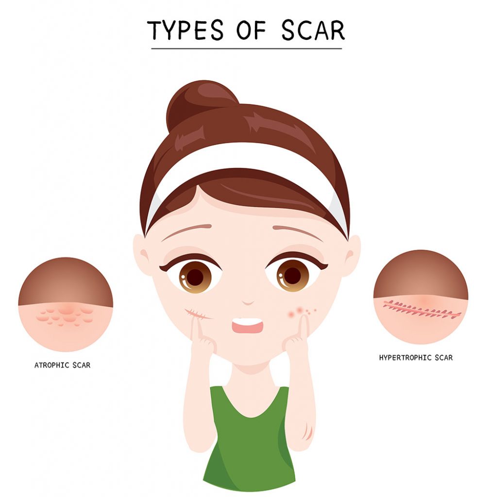 Acne scars - How do you treat them? - Arium Clinic | Medical Aesthetics